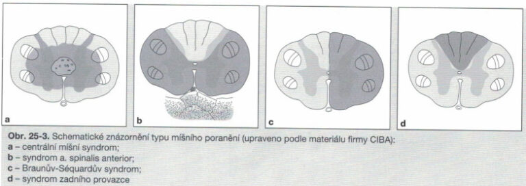 Poranenia miechy - Medicína a chirurgia