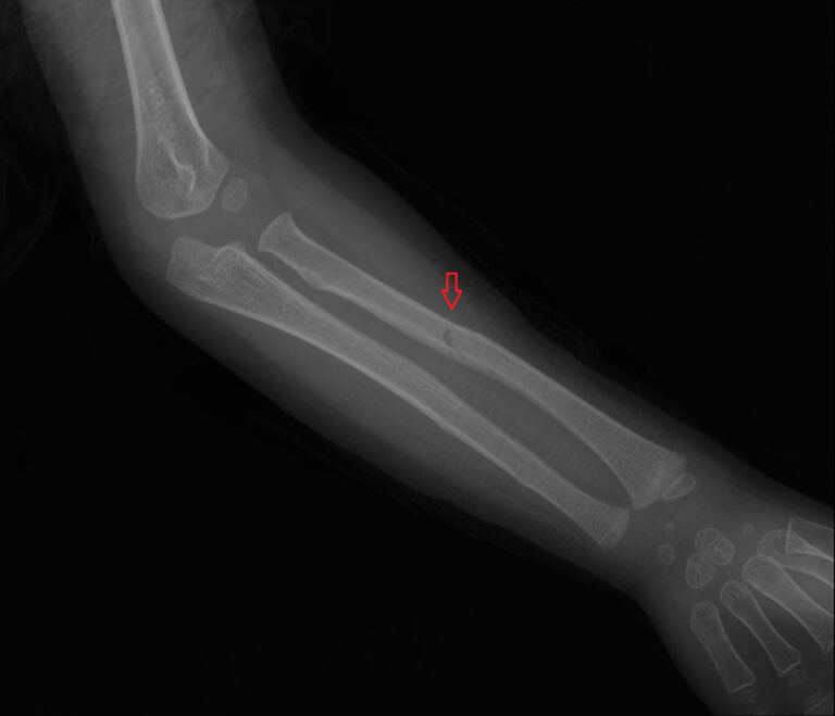 Zlomeniny predlaktia a zápästia - Medicína a chirurgia